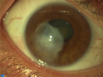 Il prof. Paolo Rama spiega com'è fatta la cornea dell'occhio